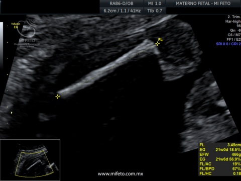 Ultrasonido Estructural - Mi Feto